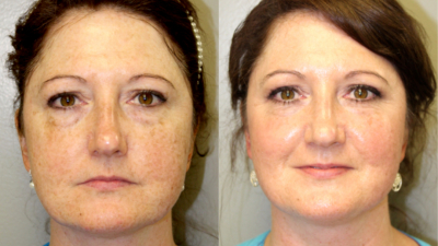 Patient #65833 Before & After Photos Raleigh, NC