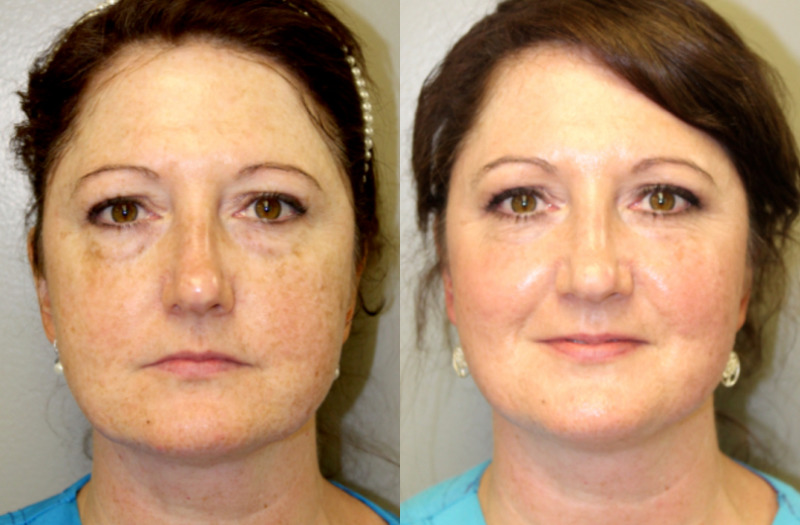 Patient #65833 Before & After Photos Raleigh, NC