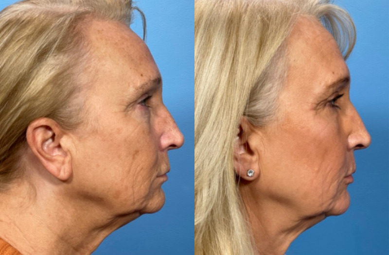 DEKA SmartXide Tetra CO2 Laser Therapy Before and After Photos Raleigh ...